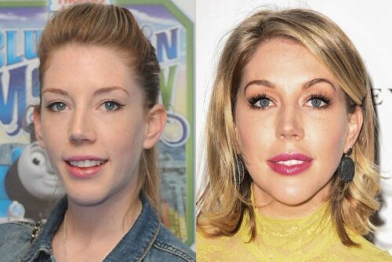 Has Katherine Ryan had cosmetic surgery? | MYA Cosmetic Surgery
