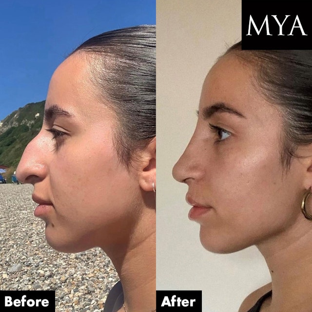 Has Jessica Alba Had Cosmetic Surgery? | MYA Cosmetic Surgery