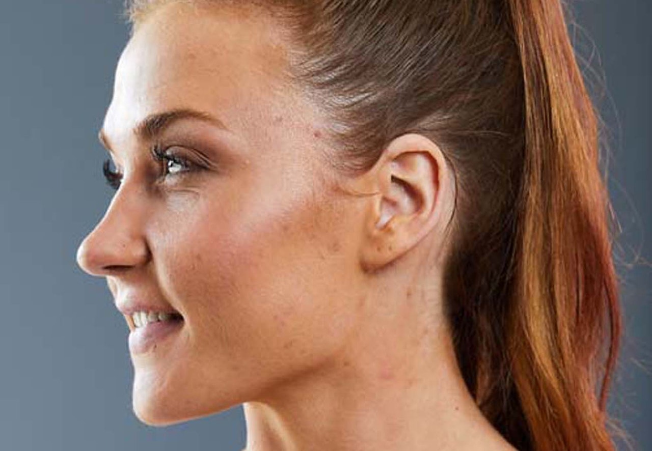 Ear Reshaping | Otoplasty | Ear Surgery | MYA Cosmetic Surgery