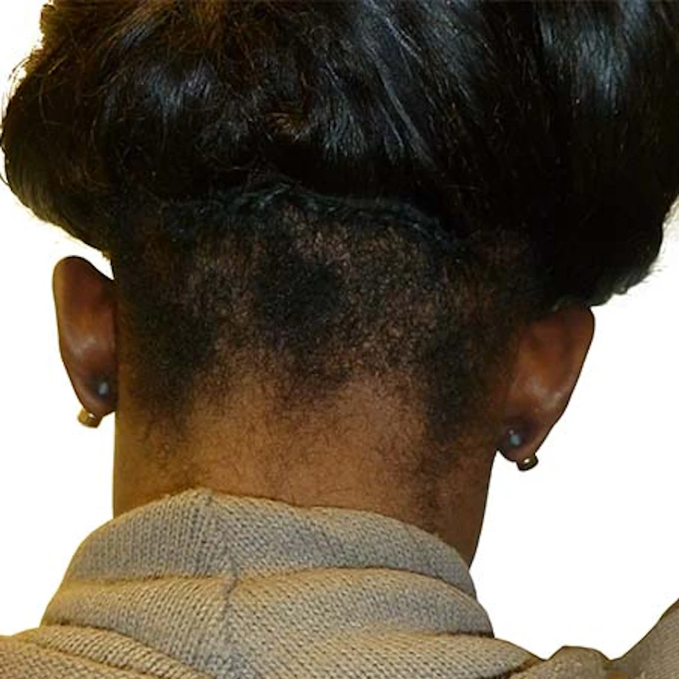 Ear Reshaping | Otoplasty | Ear Surgery | MYA Cosmetic Surgery
