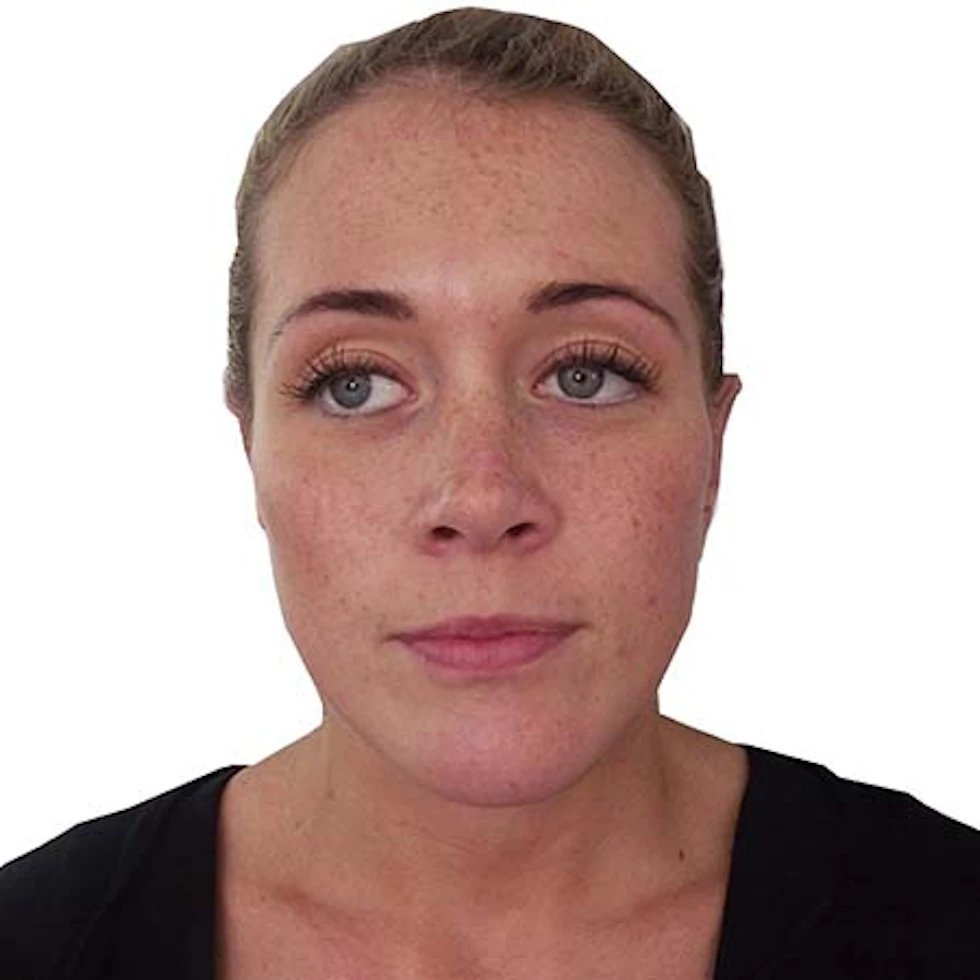 Ear Reshaping | Otoplasty | Ear Surgery | MYA Cosmetic Surgery