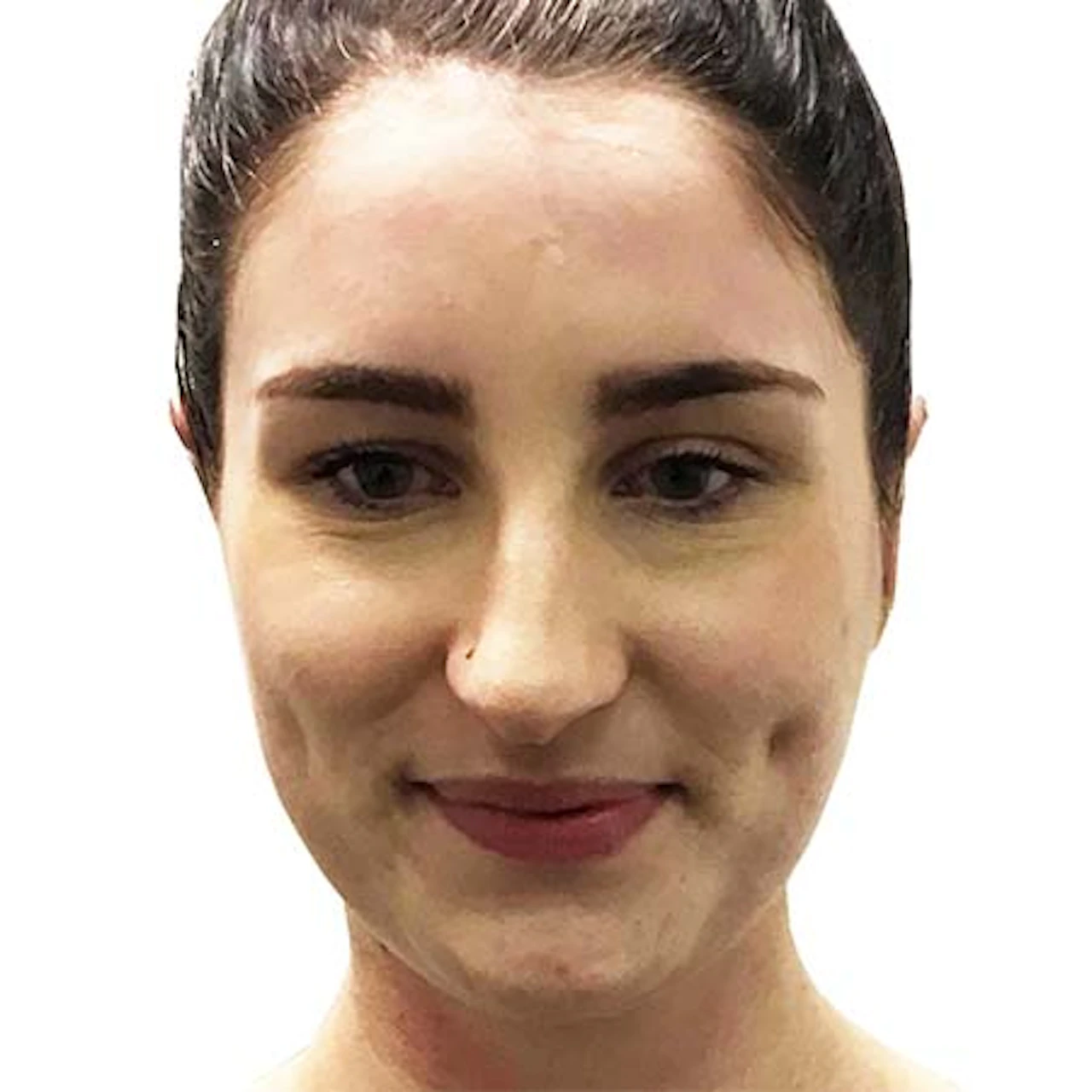Ear Reshaping | Otoplasty | Ear Surgery | MYA Cosmetic Surgery