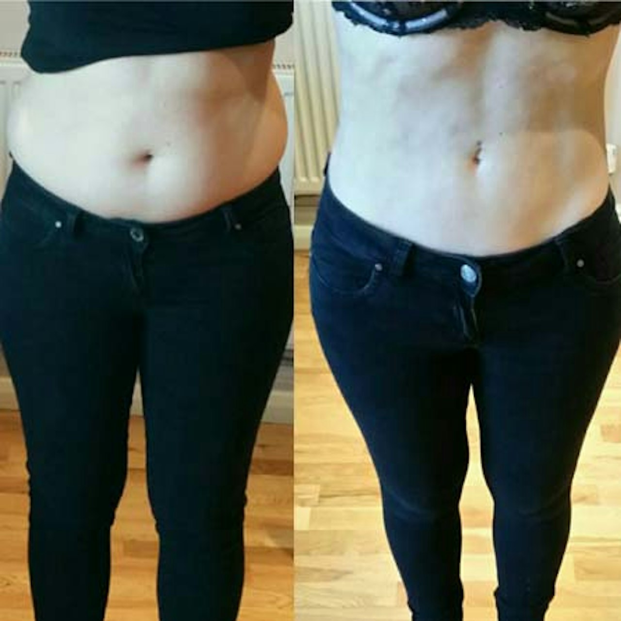 Liposuction | Liposuction Surgery & Fat Removal UK | MYA