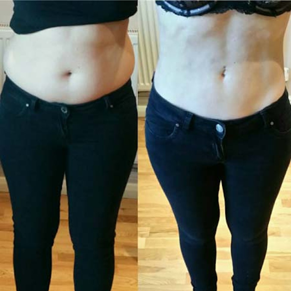 Liposuction | Liposuction Surgery & Fat Removal UK | MYA