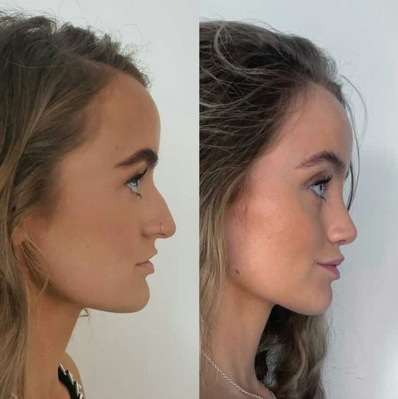 Rhinoplasty | Nose Jobs & Nose Reshaping | MYA Cosmetic Surgery