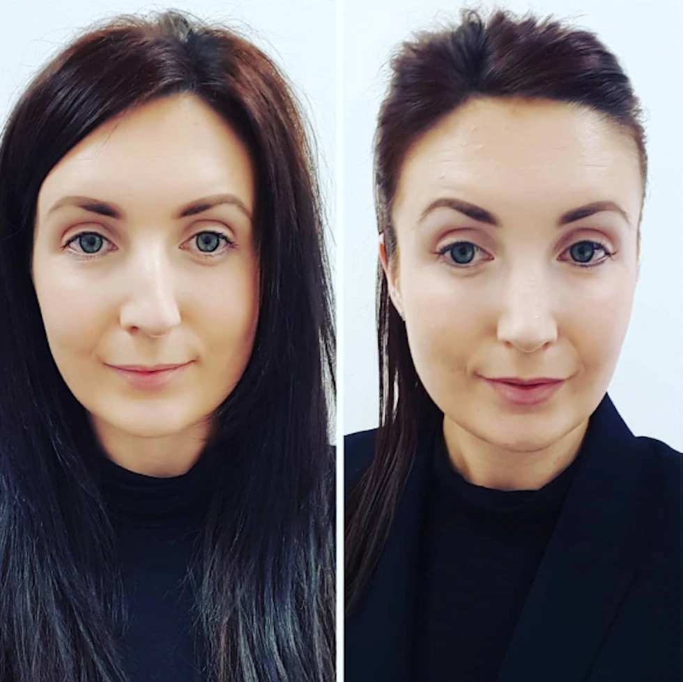 Deviated septum surgery: The cost, benefits, recovery and more | MYA