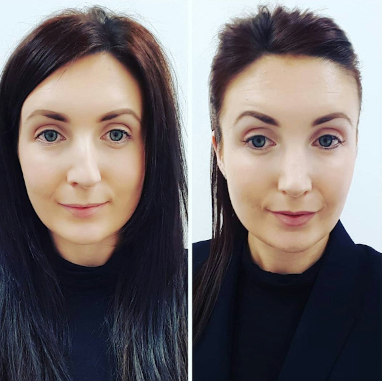 Deviated septum surgery: The cost, benefits, recovery and more | MYA