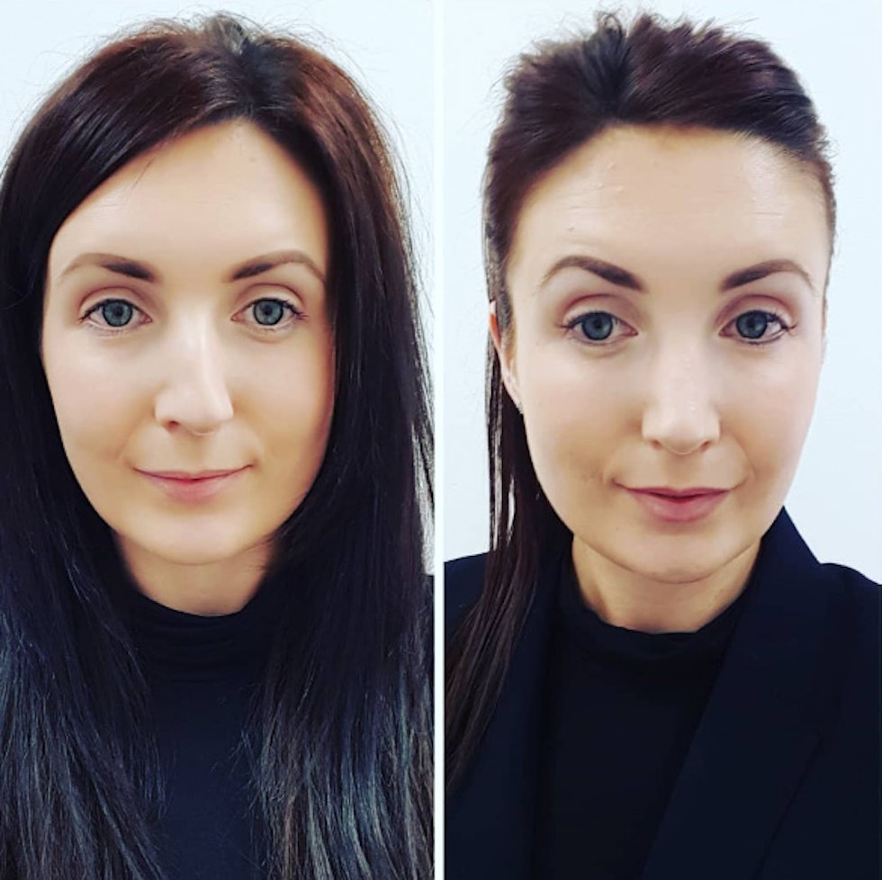 Deviated septum surgery: The cost, benefits, recovery and more | MYA